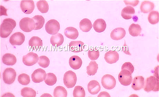 Identify erythrocyte abnormalities ? ~ Medical OSCES